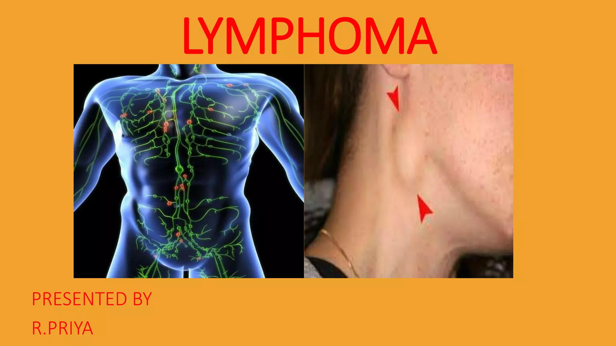 Lymphoma | PPTX