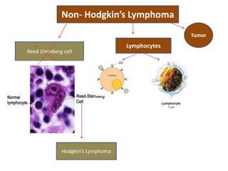 LYMPHOMA.pptx