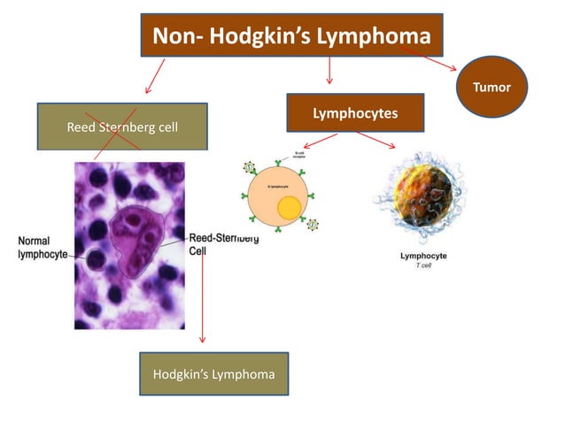LYMPHOMA.pptx | Free Download