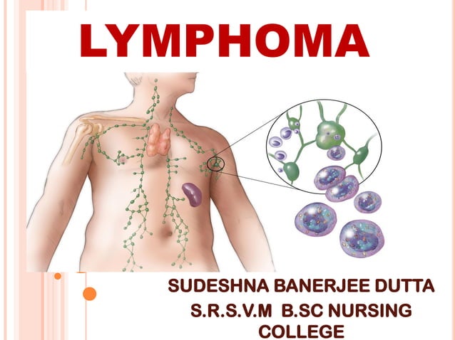 Lymphoma | PDF