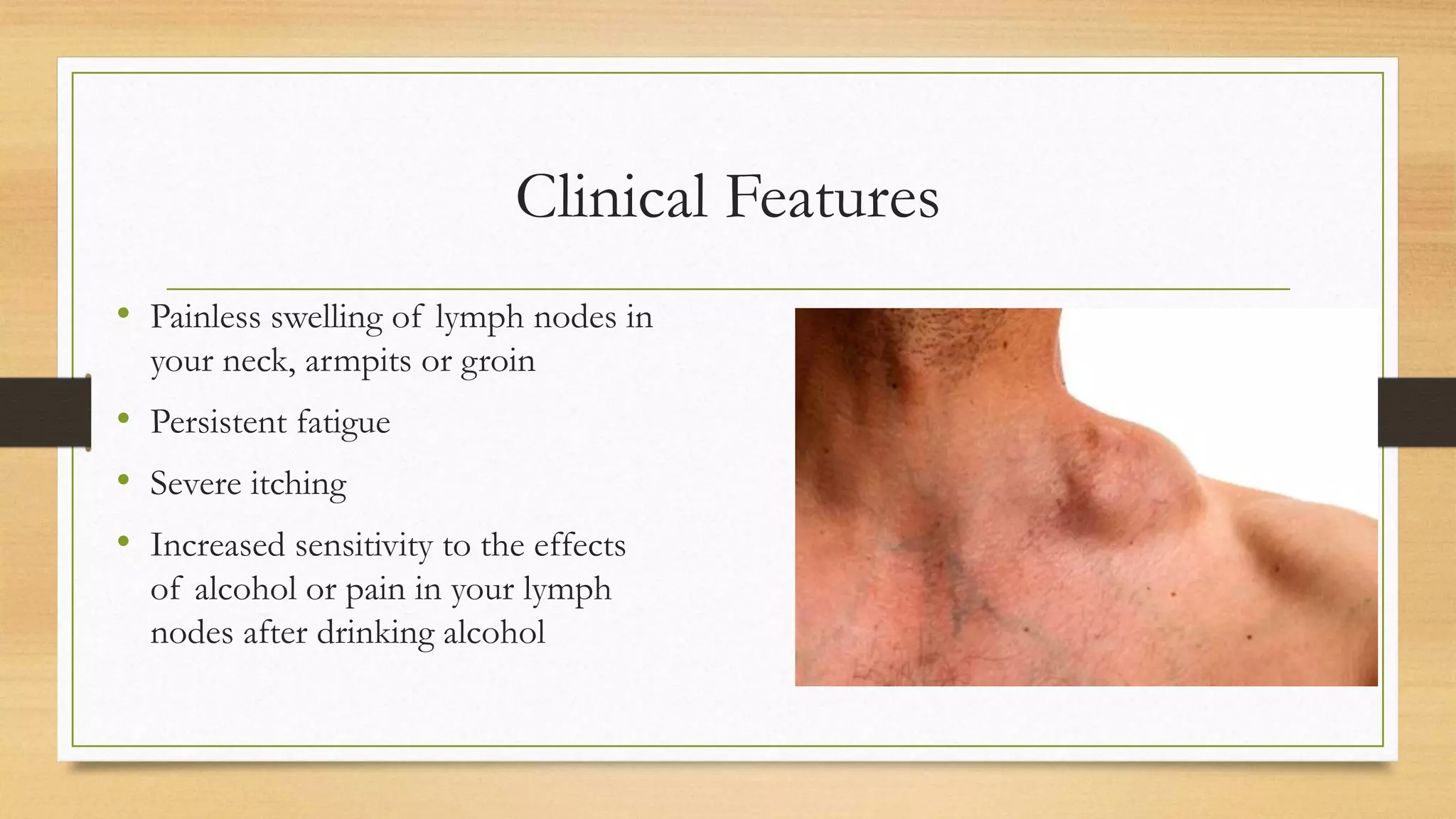 Hodgkin Lymphoma - Diagnosis to Management | PPTX