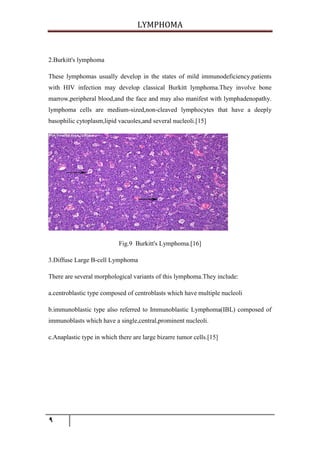 Lymphoma | PDF