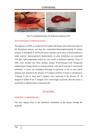 Lymphoma | PDF
