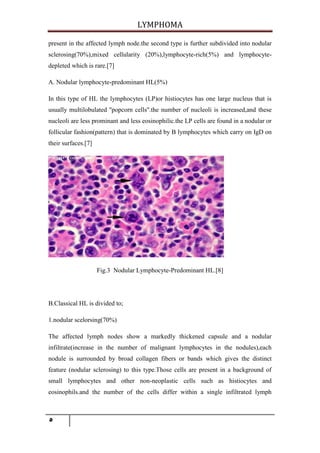Lymphoma | PDF