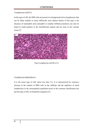 Lymphoma | PDF