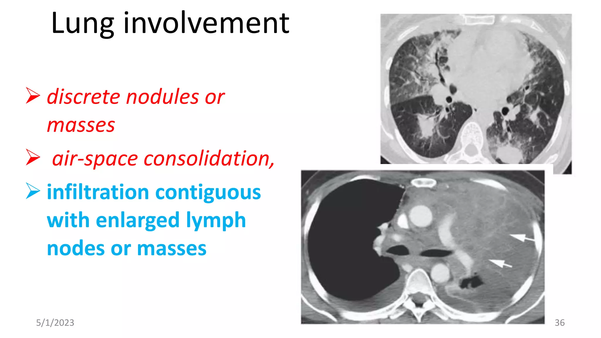 Lymphoma AND LPD.pptx