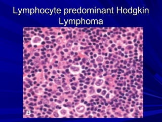Lymphoma Slide