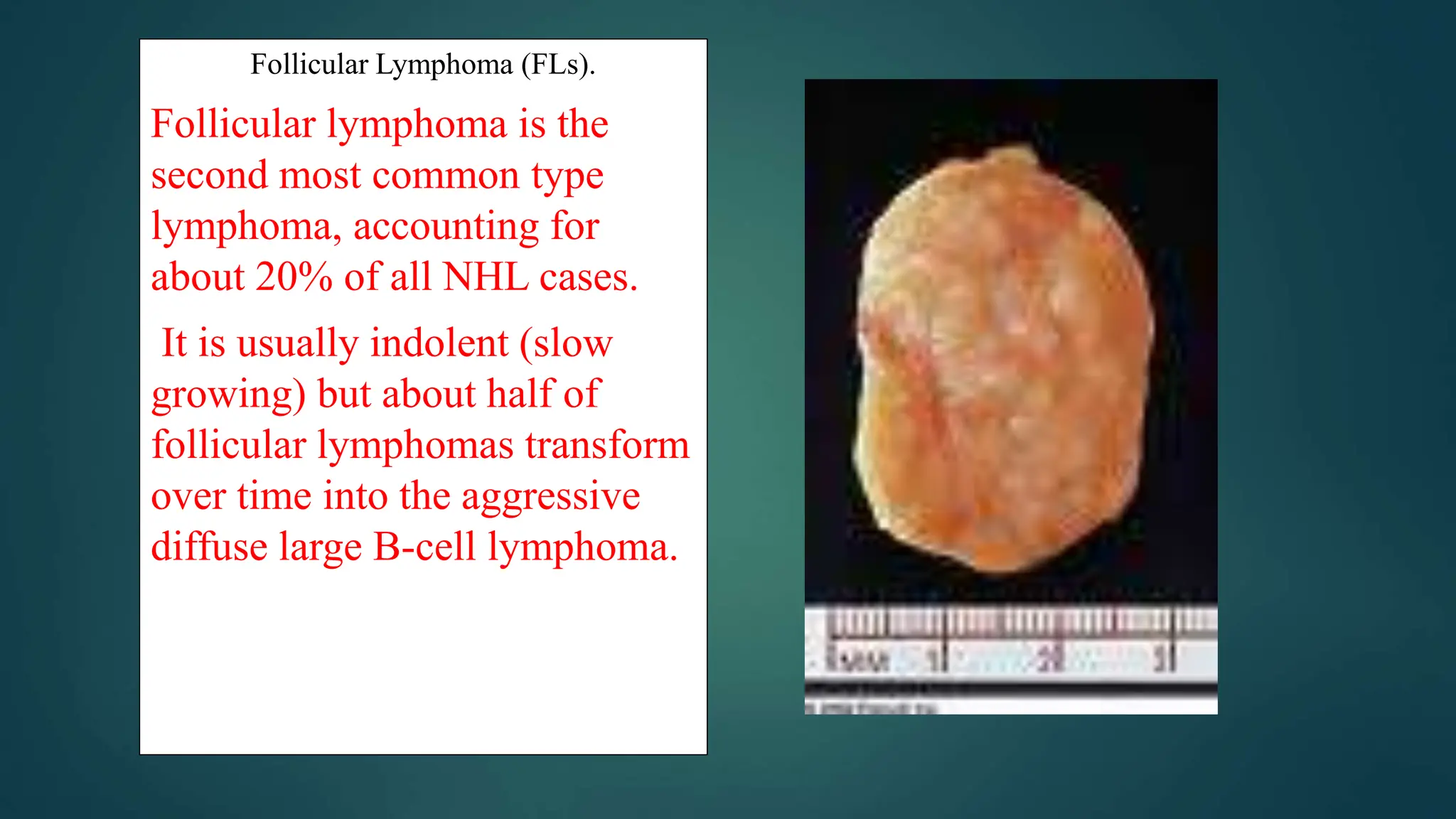 LYMPHOMA final1.pptxcdfhfhfhgfhfghfhgdhhf | PPTX