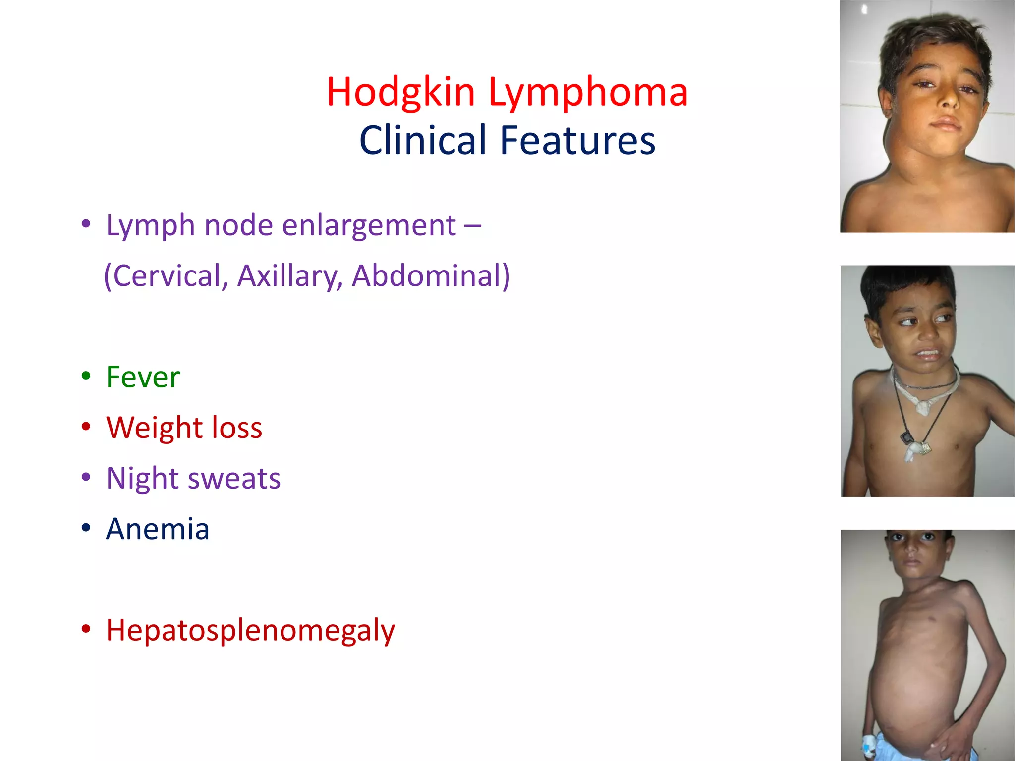 Lymphoma in children 2021 | PDF