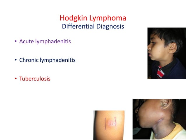 Lymphoma in children 2021 | PDF | Blood Disorders | Diseases and Conditions