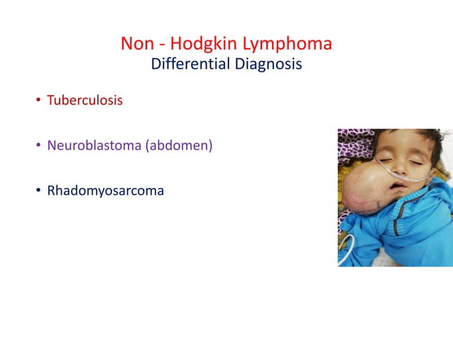 Lymphoma in children 2021 | PDF | Blood Disorders | Diseases and Conditions