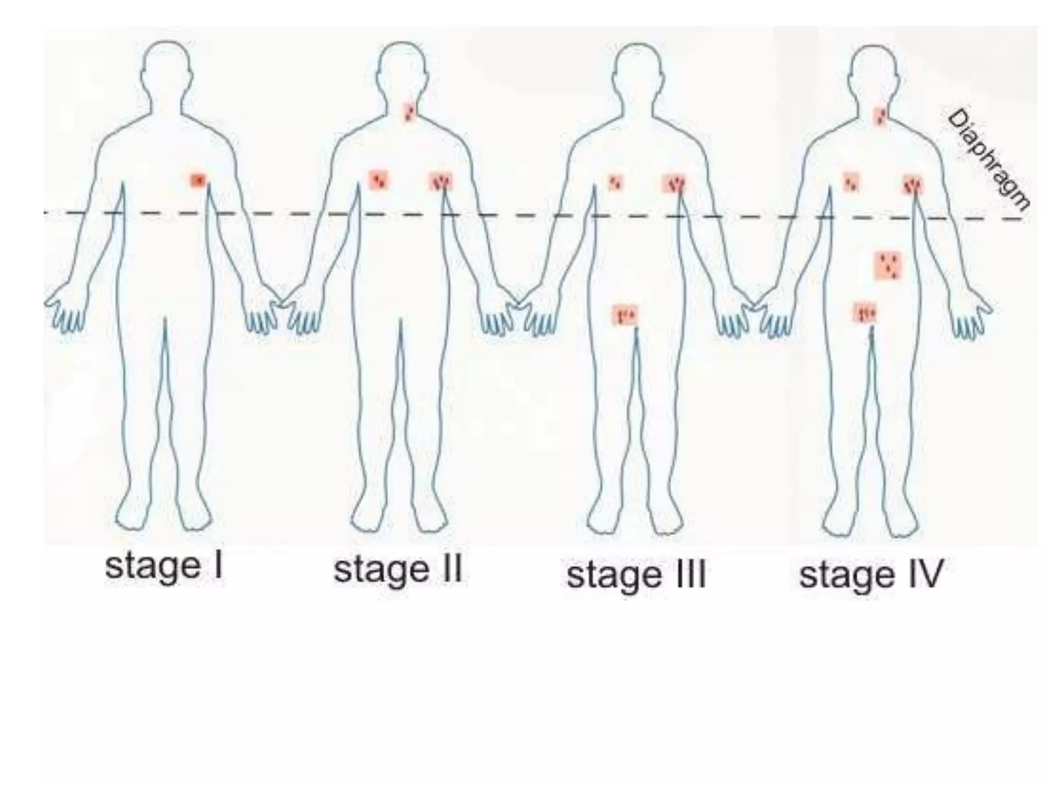 Lymphoma in children Dr G.Rajkumar | PPTX