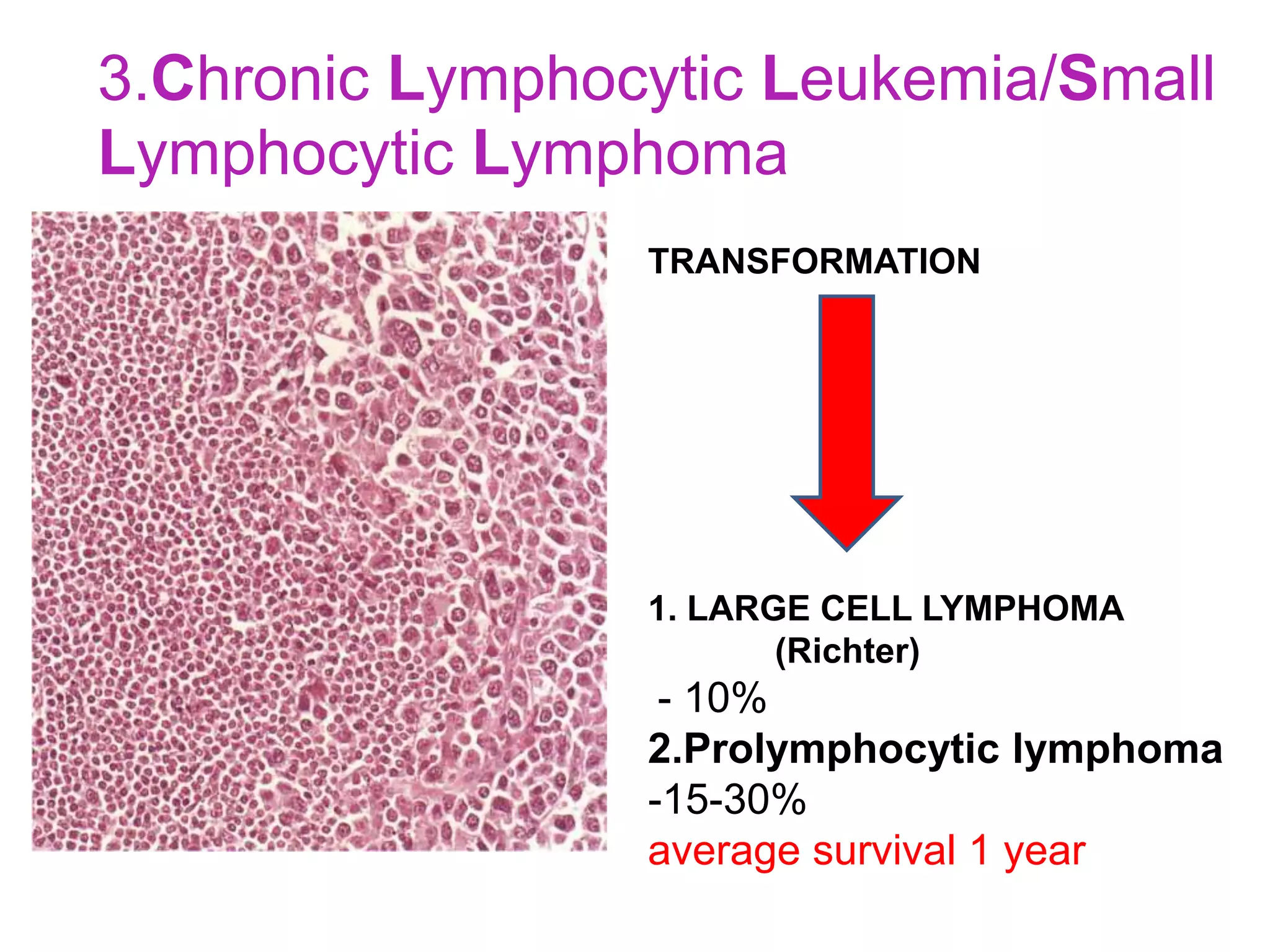 Lymphoma lecture(1) | PPTX