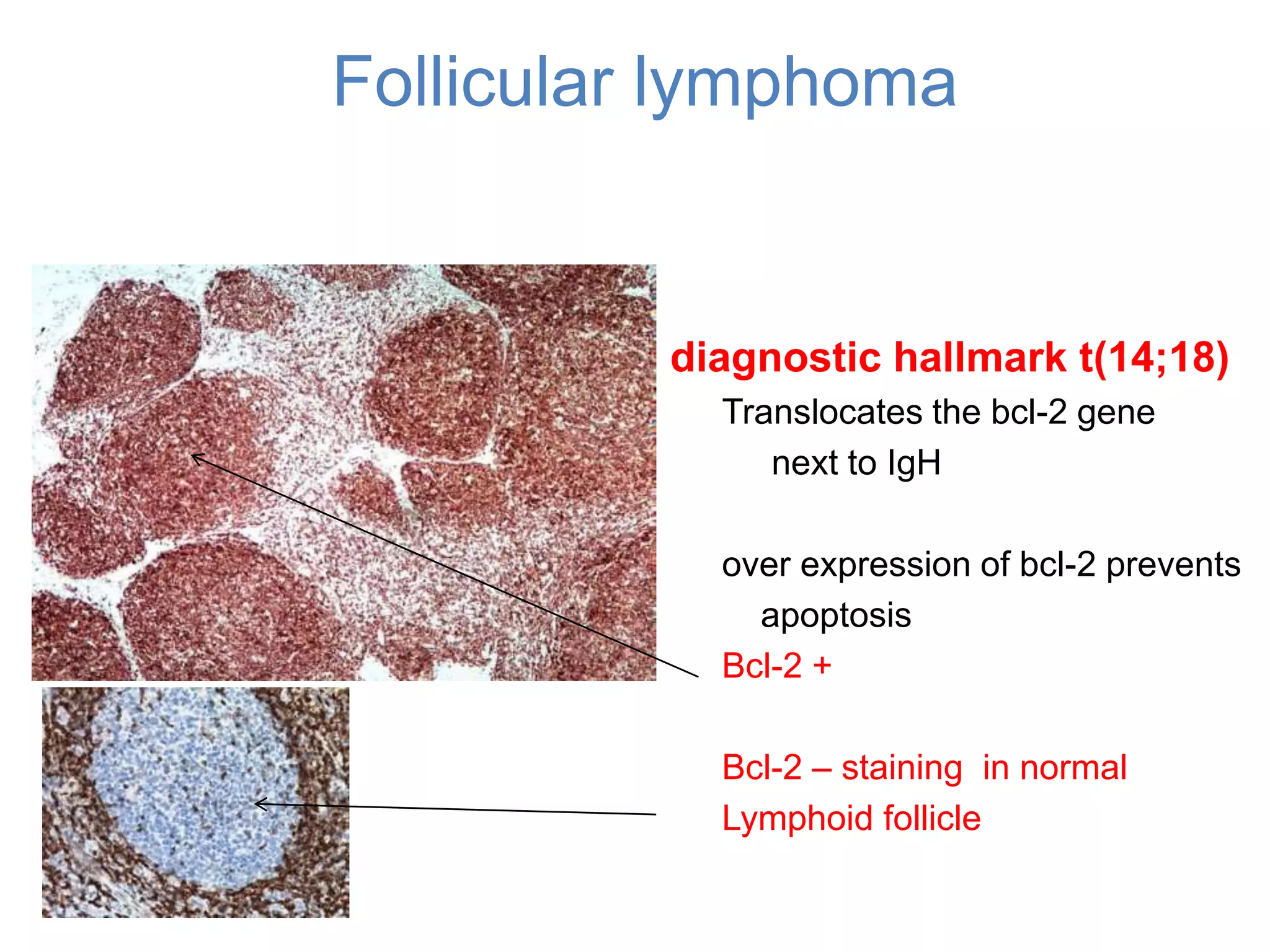 Lymphoma lecture(1) | PPTX