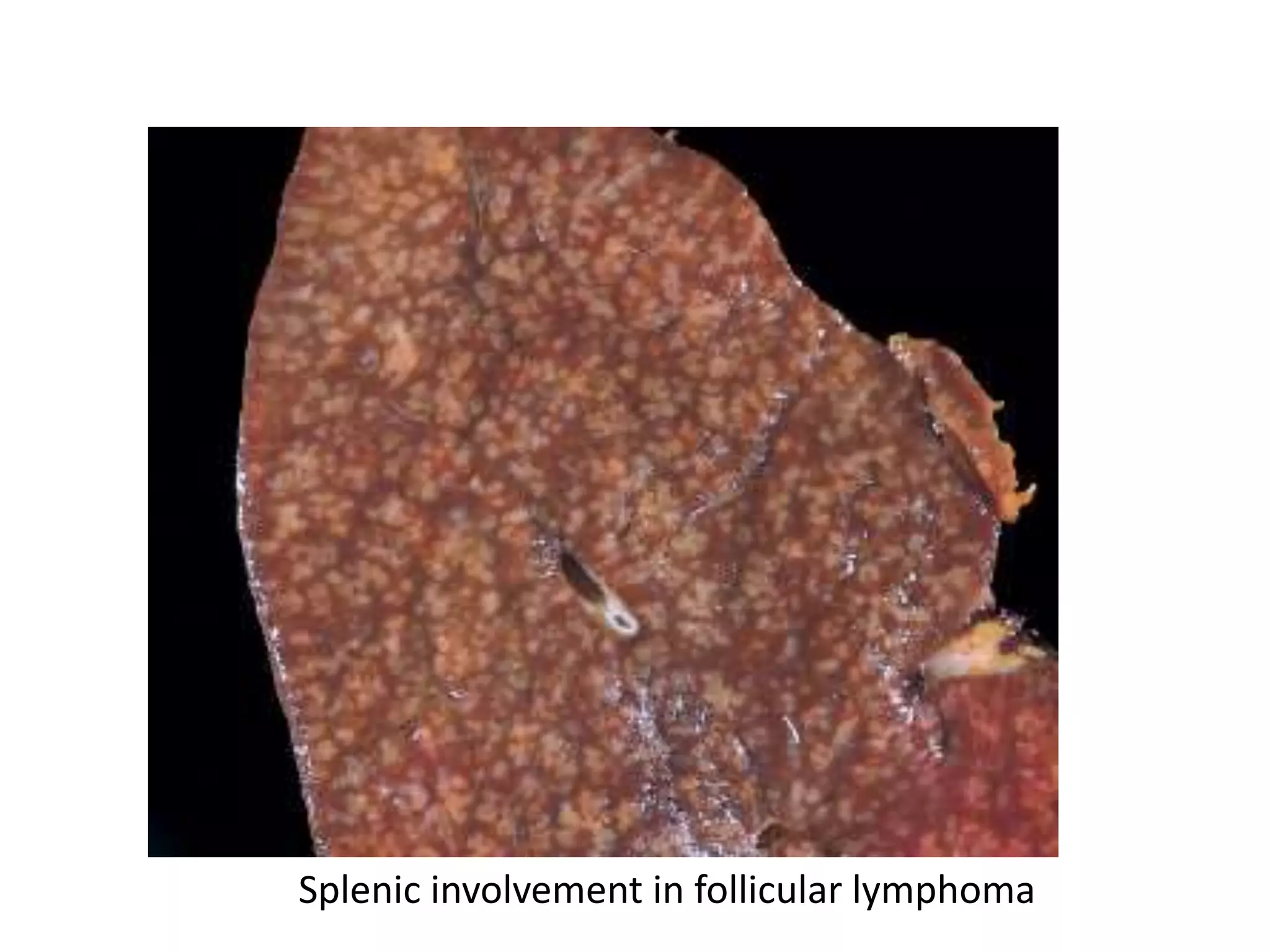Lymphoma lecture(1) | PPTX