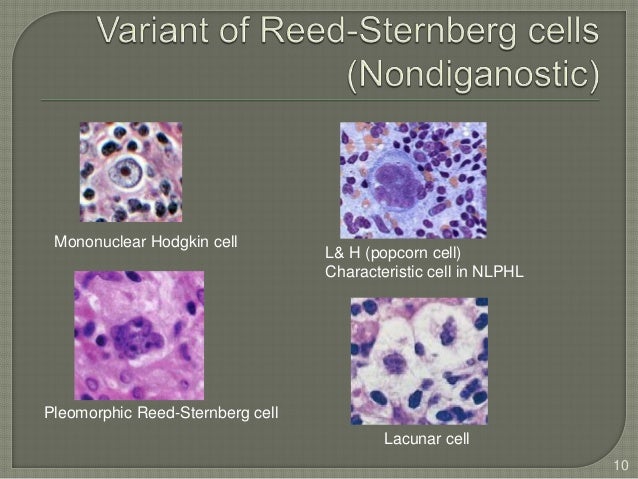Lymphomas+ Multiple Choice Questions