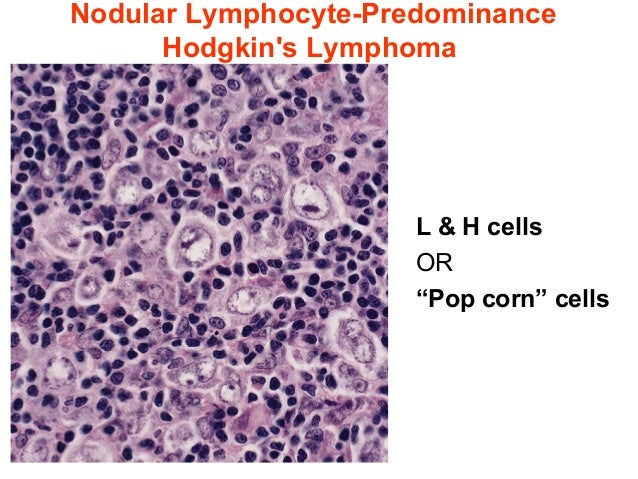 Lymphomas 2-hd