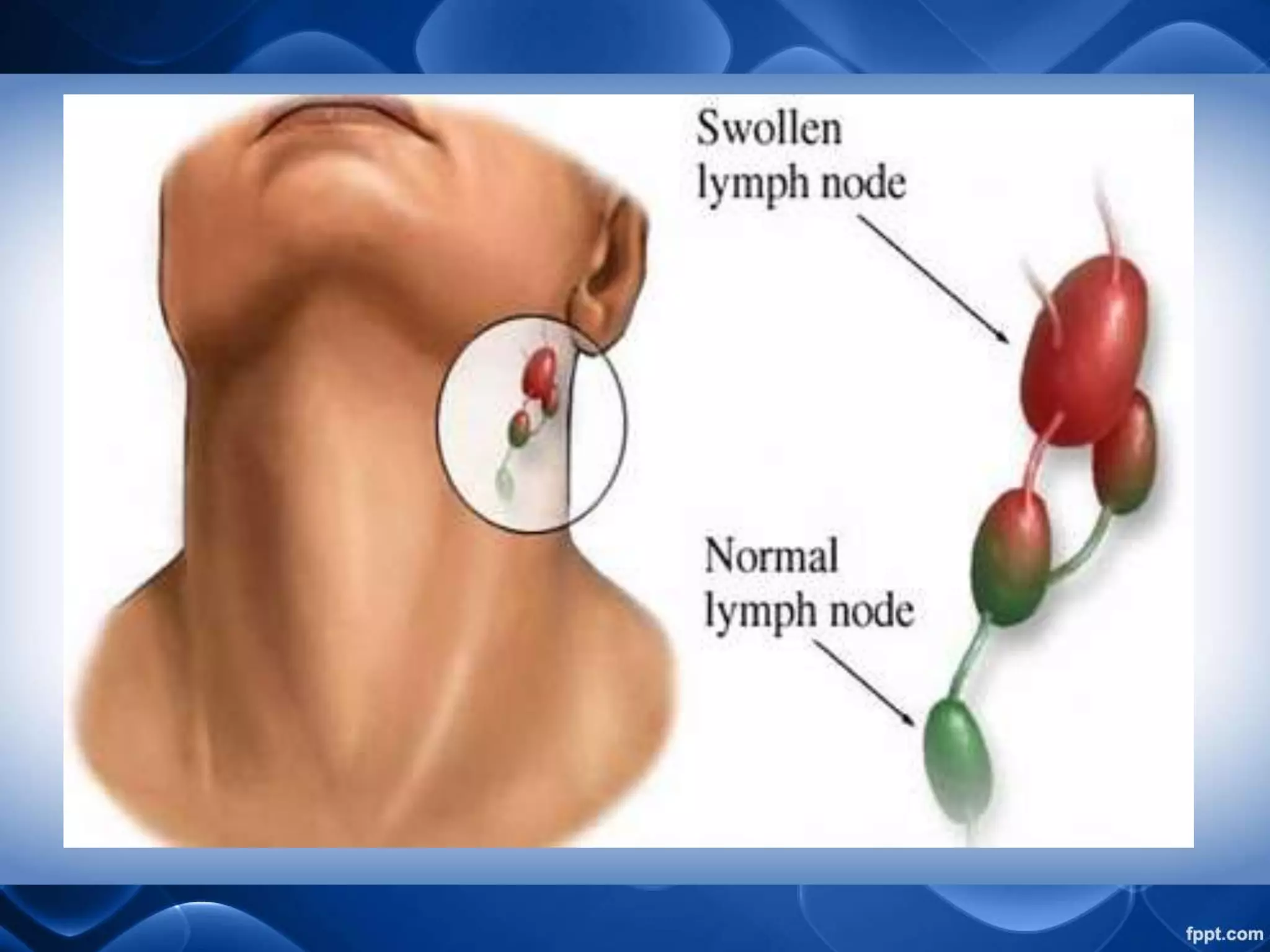 Lymphomas: Hodgkin & Non Hodgkin by Dr. Sookun Rajeev Kumar | PPT
