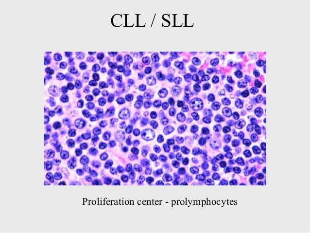 Lymphomas3