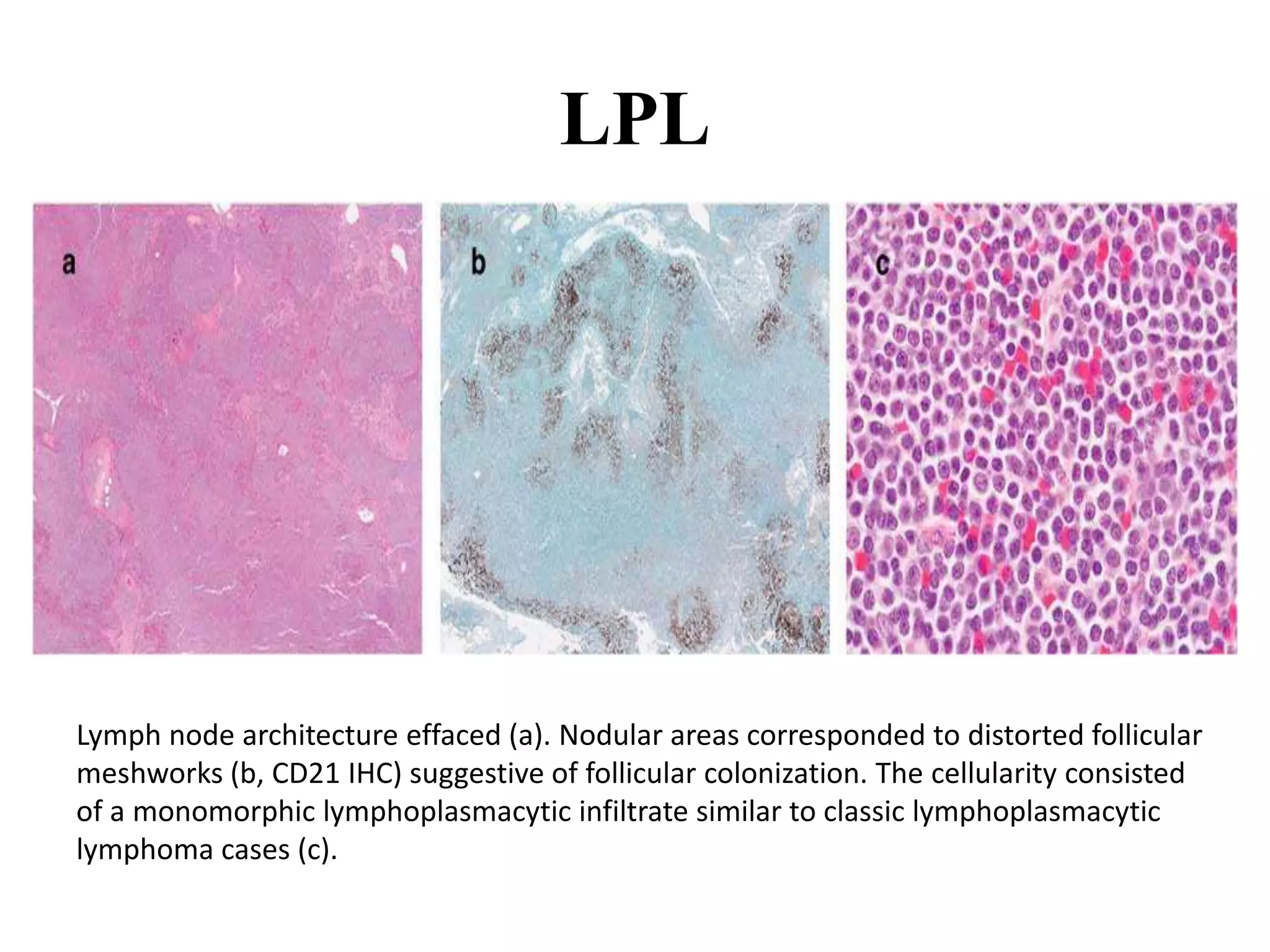 Lymphoma updates | PPTX