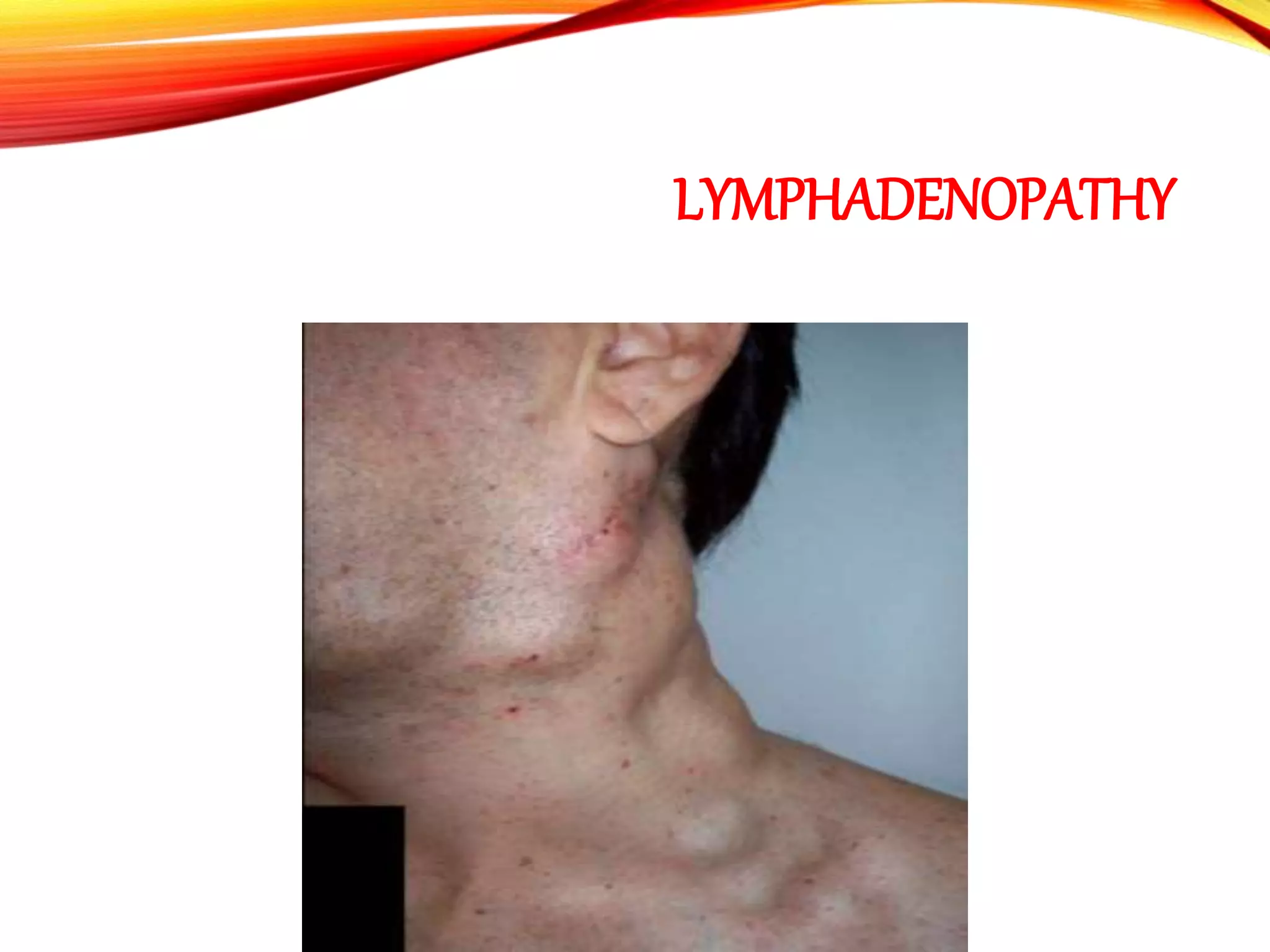 Lymphoreticular .pptx