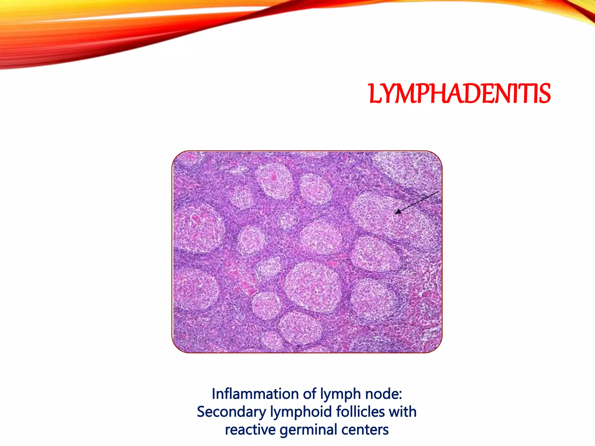 Lymphoreticular .pptx
