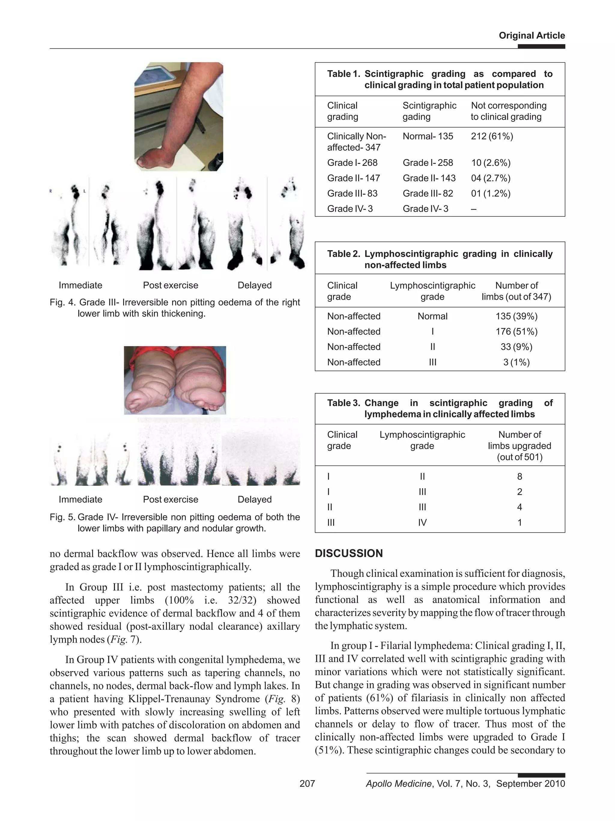 Lymphoscintigraphy As an Imaging Modality in Lymphatic System | PDF