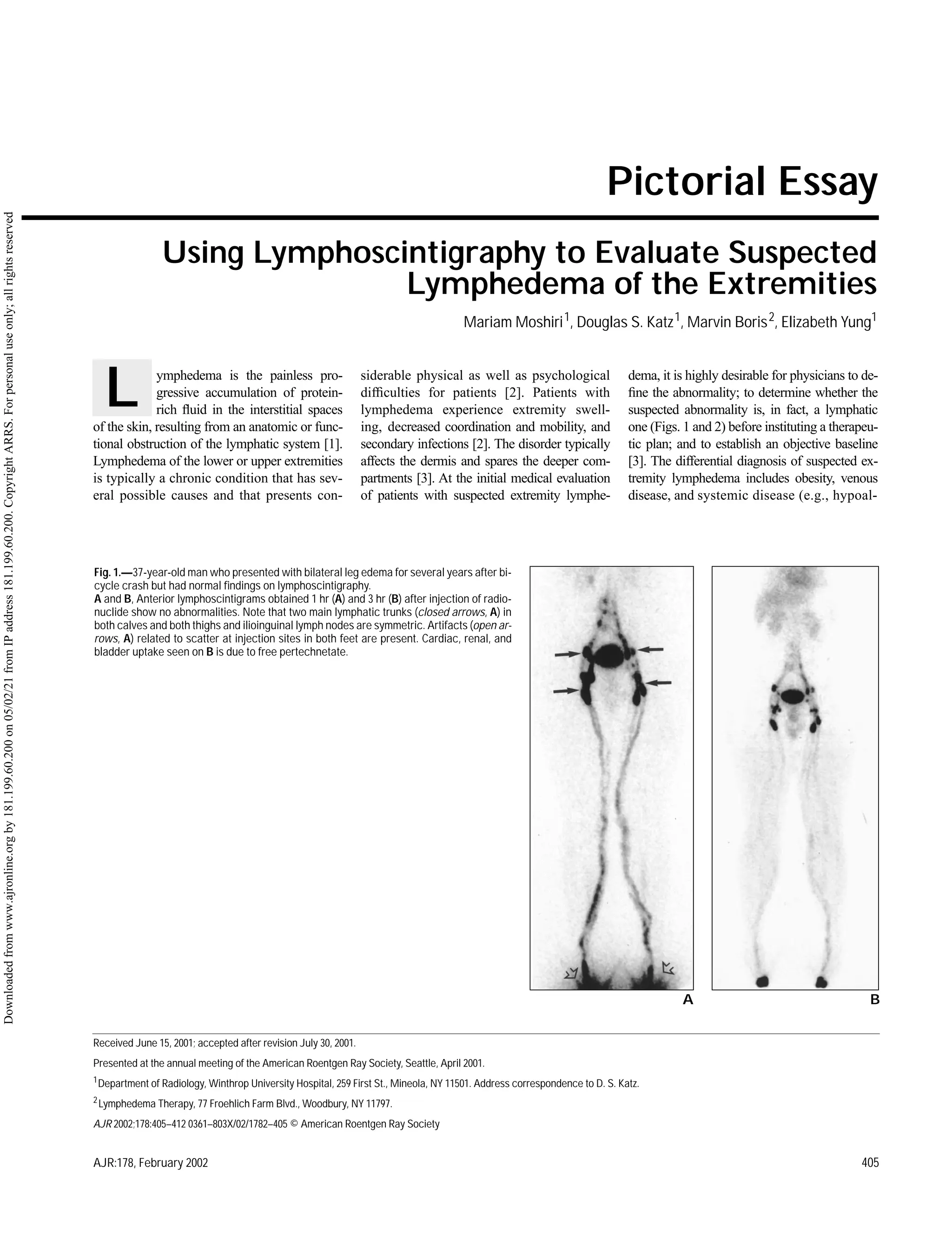 Lymphoscintigraphy lymphedema of extremities_Pictorial Essay.pdf