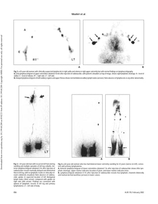 Lymphoscintigraphy lymphedema of extremities_Pictorial Essay.pdf