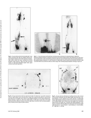Lymphoscintigraphy lymphedema of extremities_Pictorial Essay.pdf