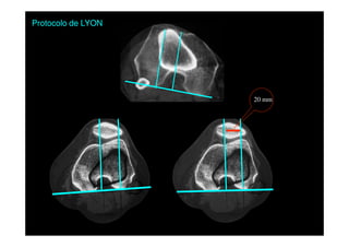 PROTOCOLO DE LYON EM TOMOGRAFIA COMPUTADORIZADA.pdf