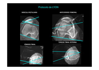 PROTOCOLO DE LYON EM TOMOGRAFIA COMPUTADORIZADA.pdf