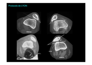 PROTOCOLO DE LYON EM TOMOGRAFIA COMPUTADORIZADA.pdf