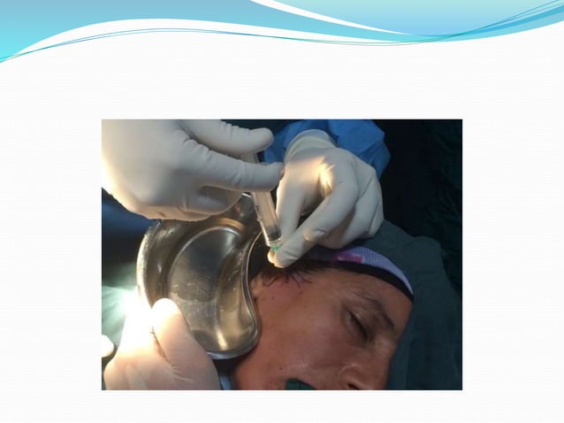 TMJ Arthrocentesis | PPTX | Pharmaceutical Drugs | Medical Health