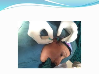 TMJ Arthrocentesis | PPT