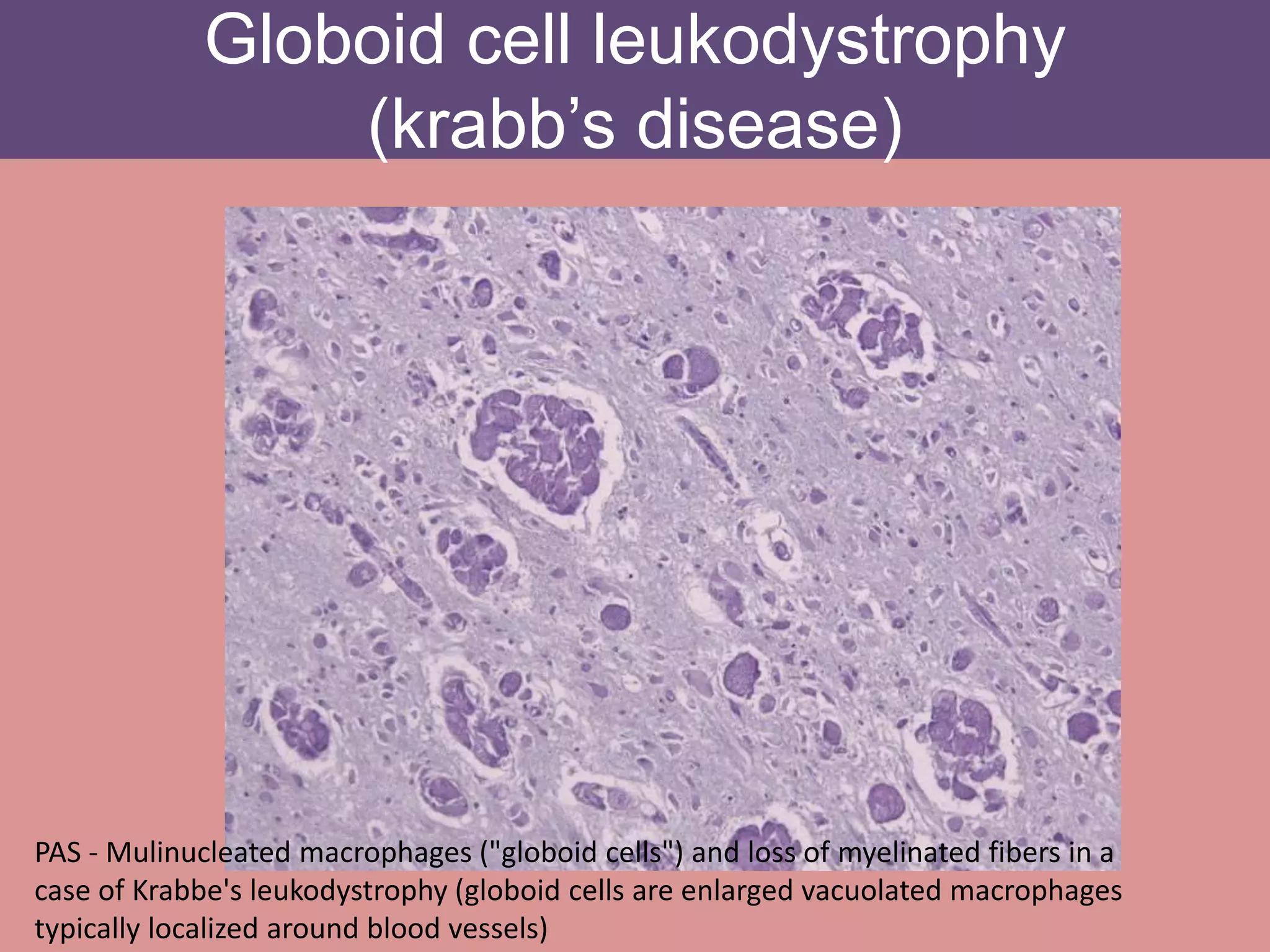 Lysosomal storage diseases | PPTX