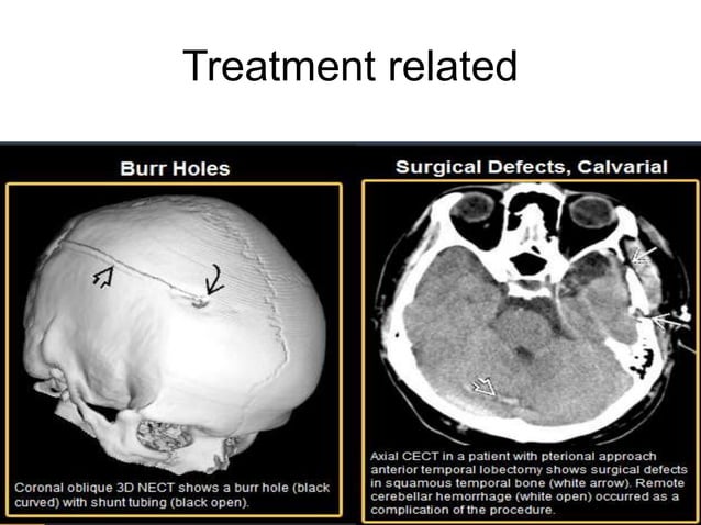 Lytic leisons of the skull | PPTX