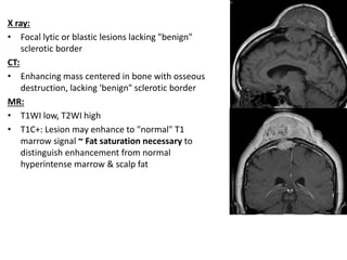 Lytic leisons of the skull | PPTX