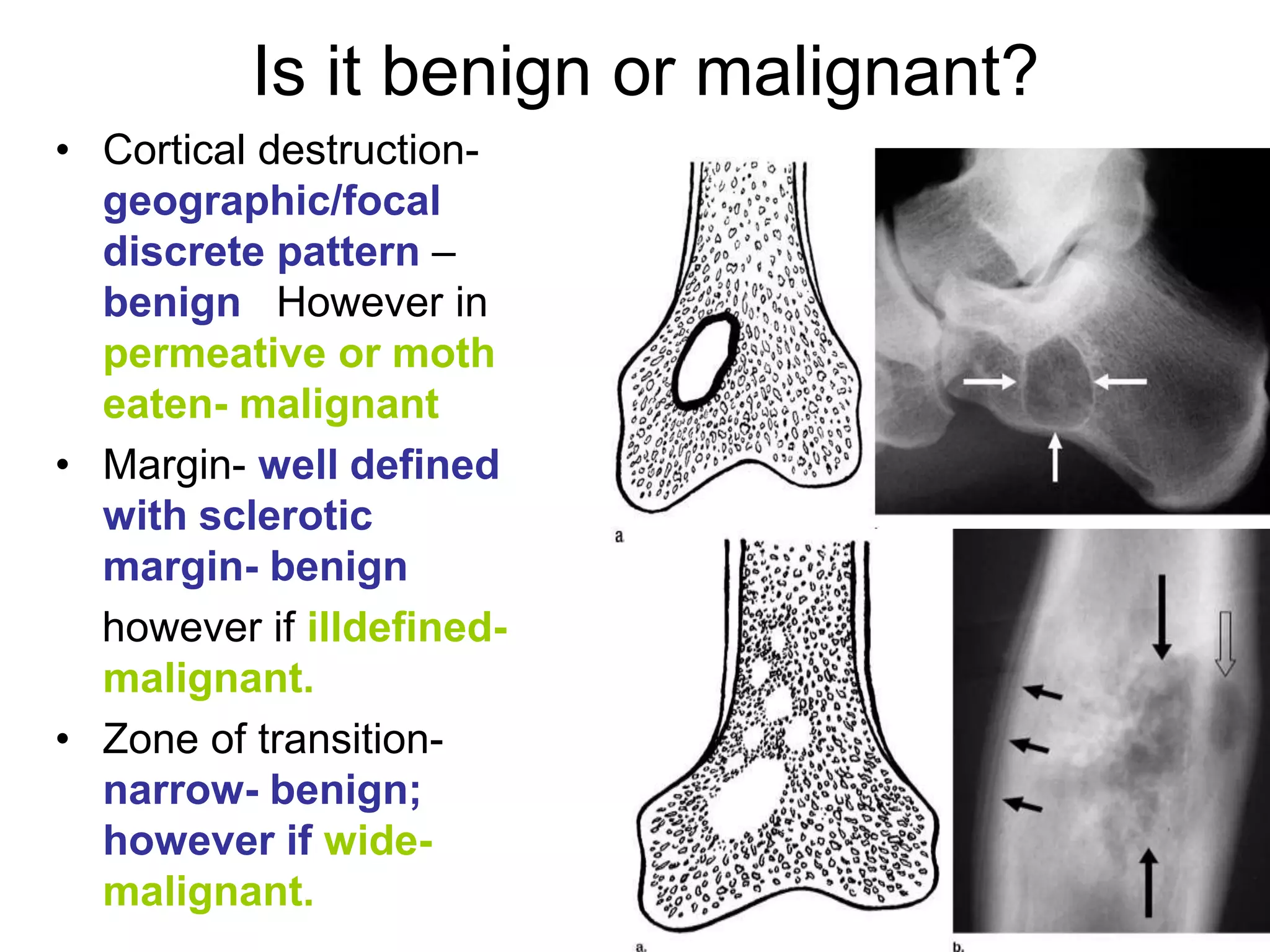 Lytic/cystic lesion of bone final | PPT