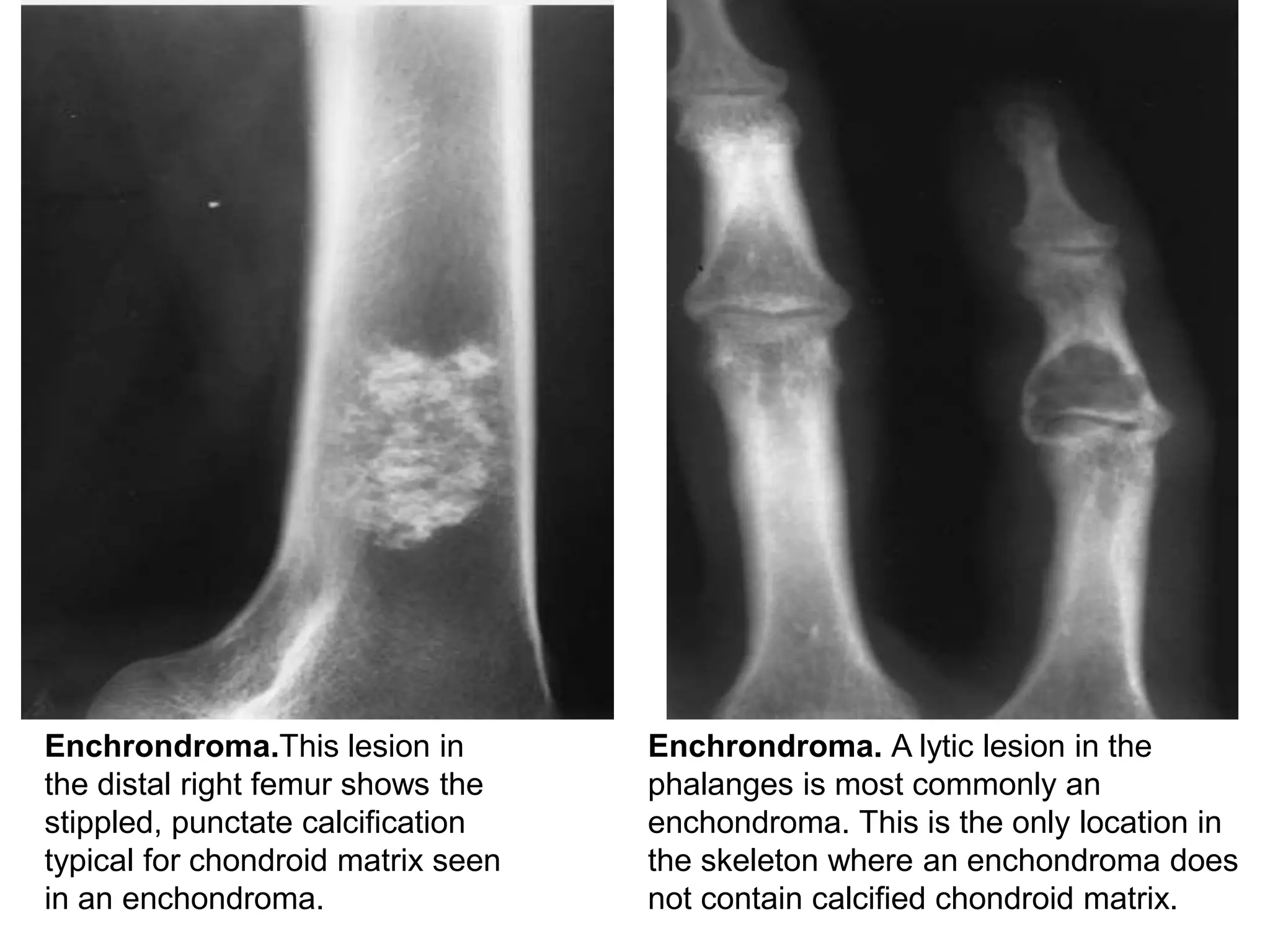 Lytic/cystic lesion of bone final | PPT
