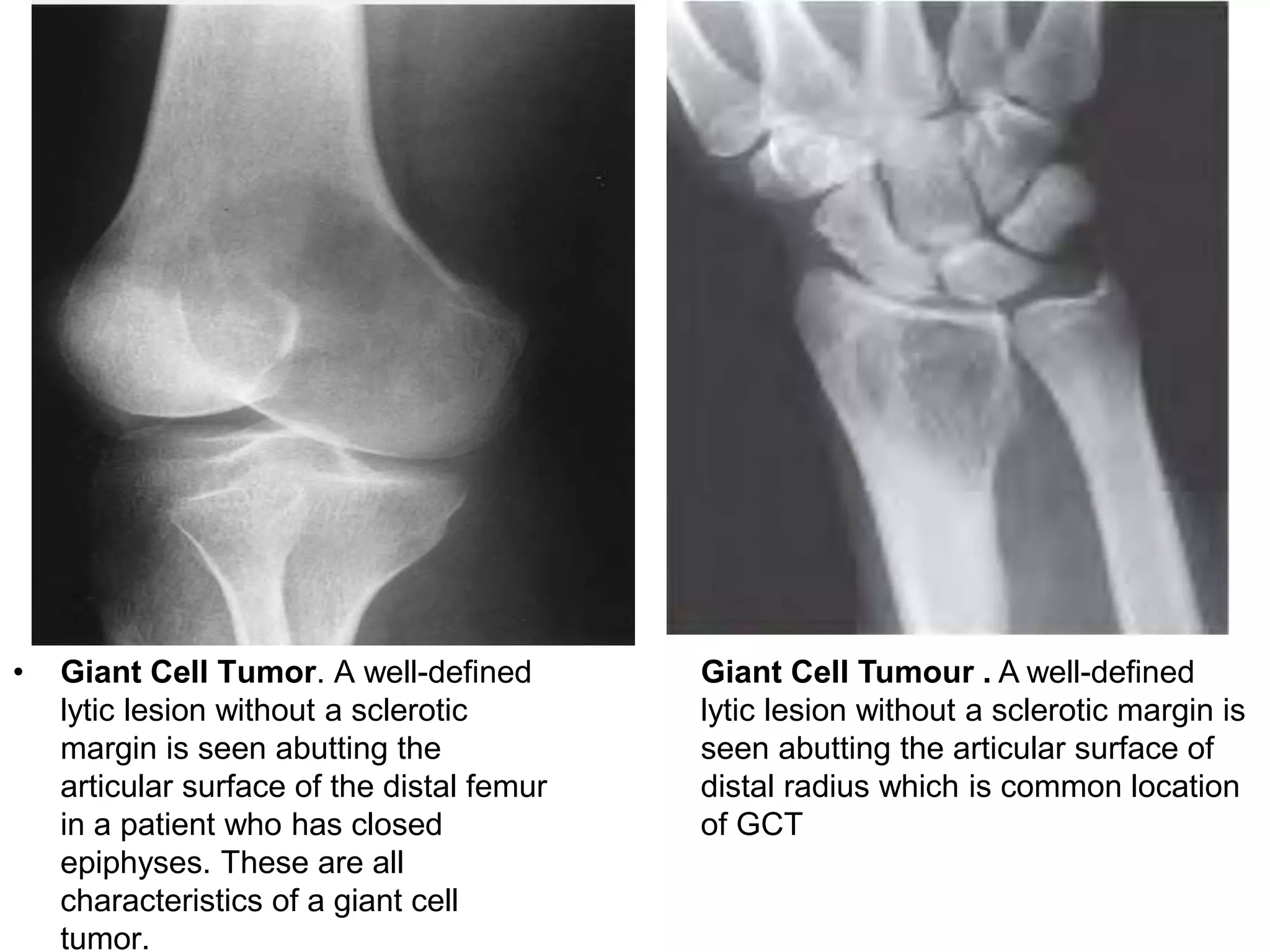 Lytic/cystic lesion of bone final | PPT