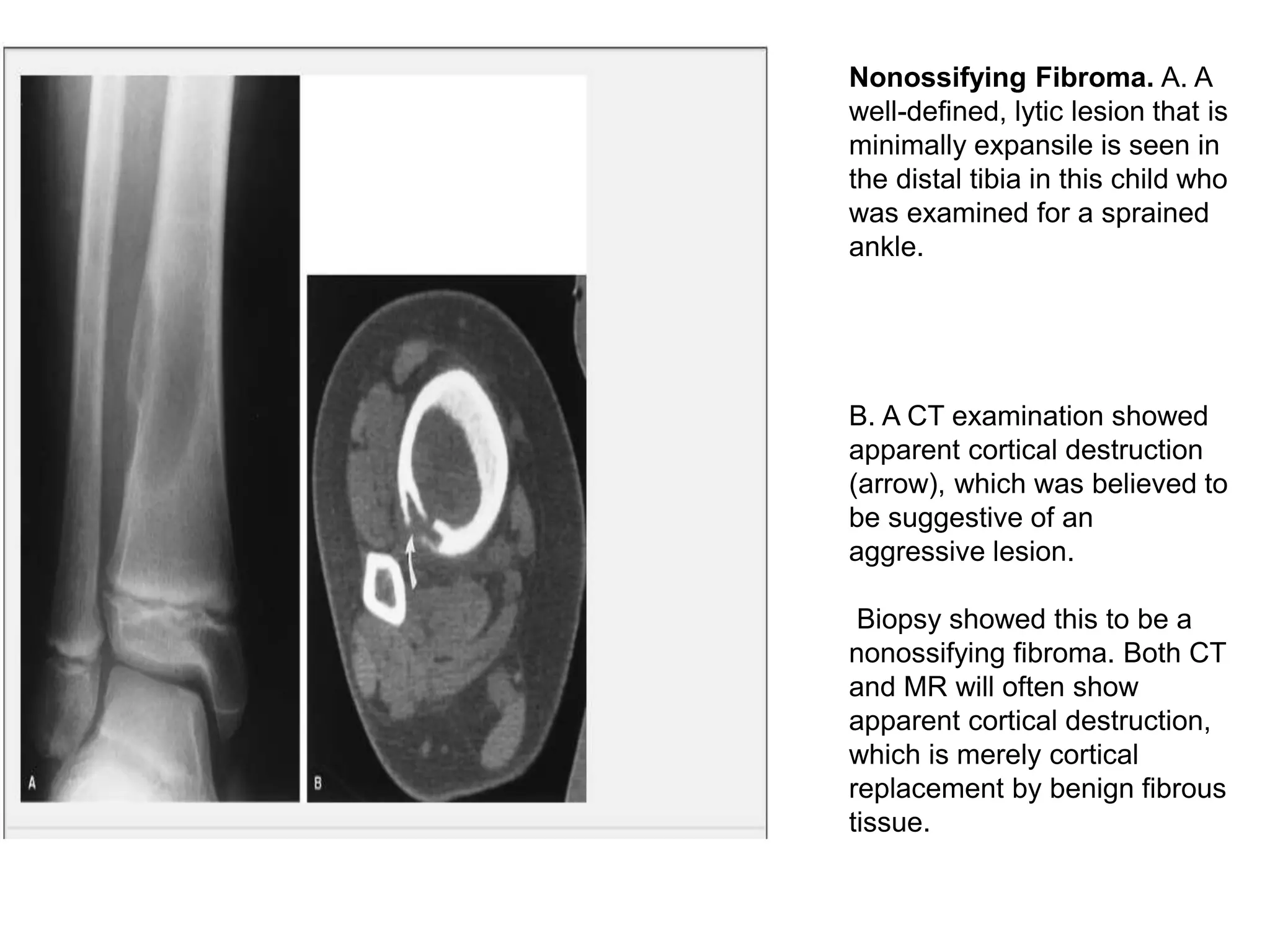 Lytic/cystic lesion of bone final | PPT