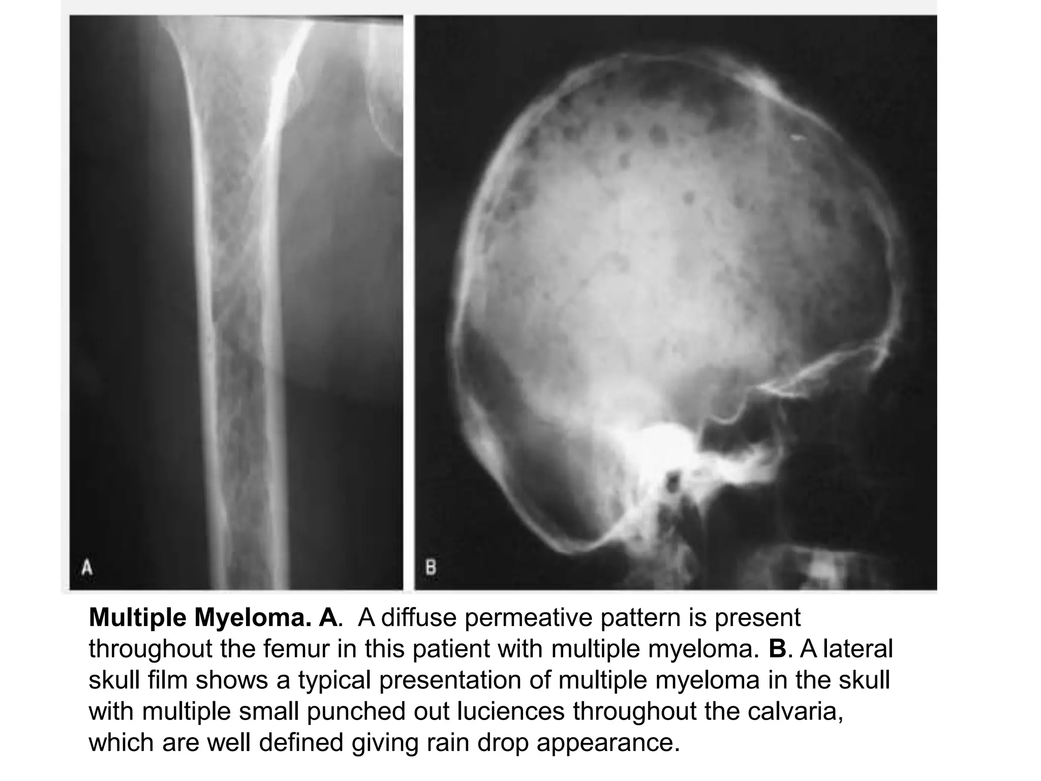 Lytic/cystic lesion of bone final | PPT