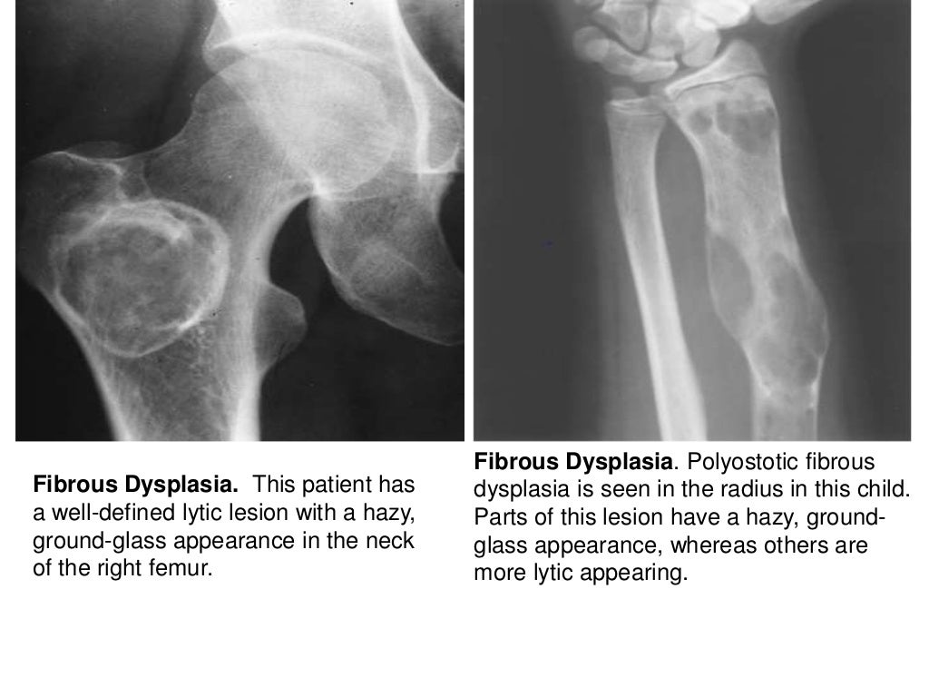 Lytic/cystic lesion of bone final