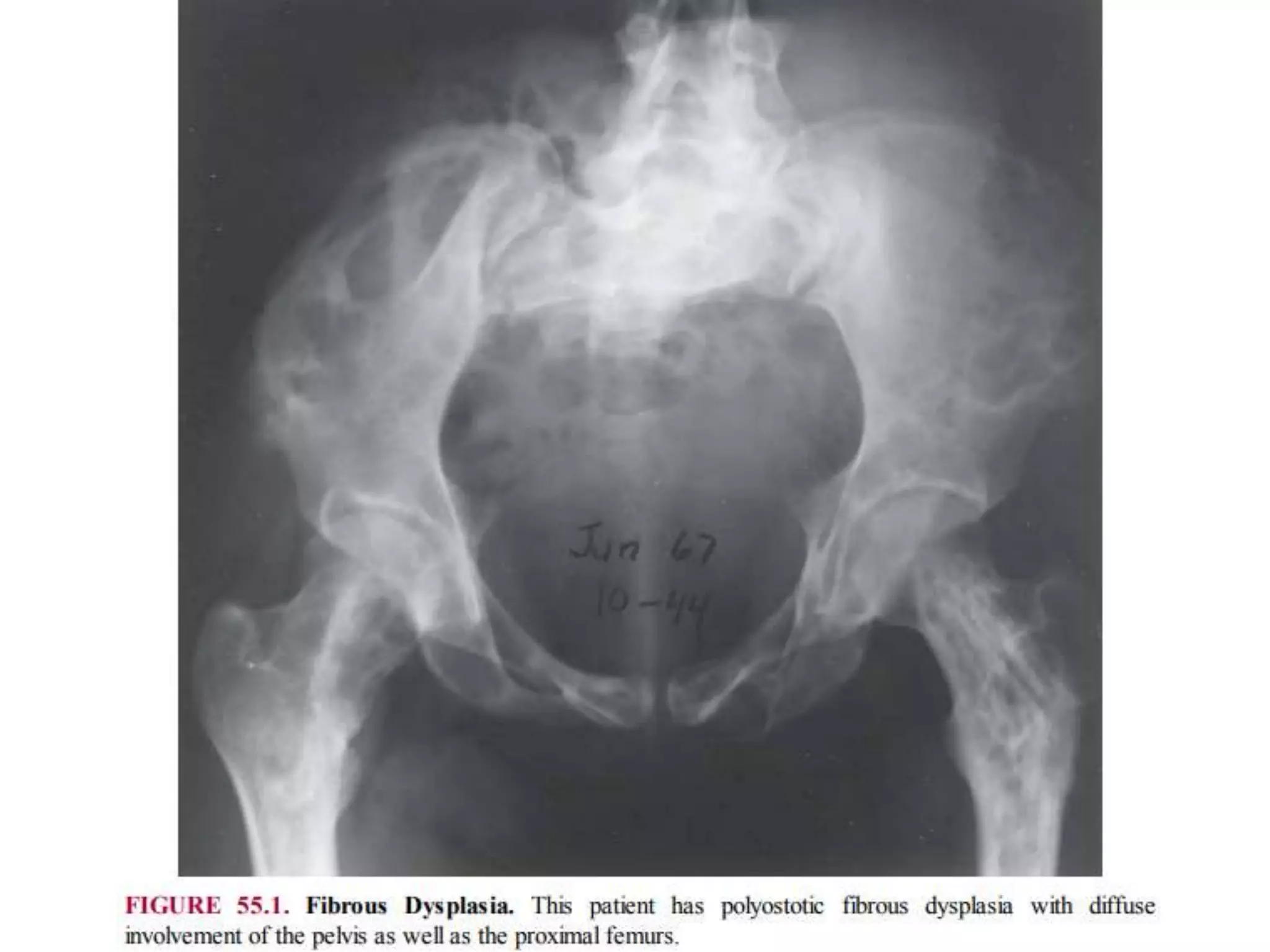 Lytic lesions of bone | PPTX