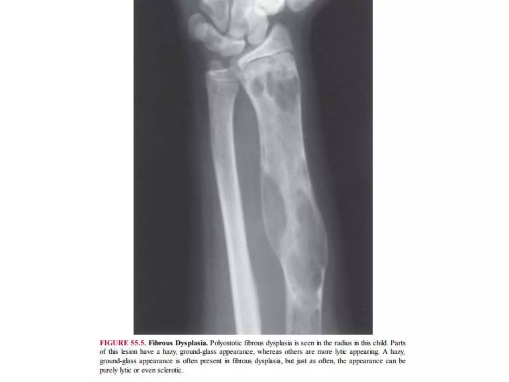 Lytic lesions of bone | PPTX