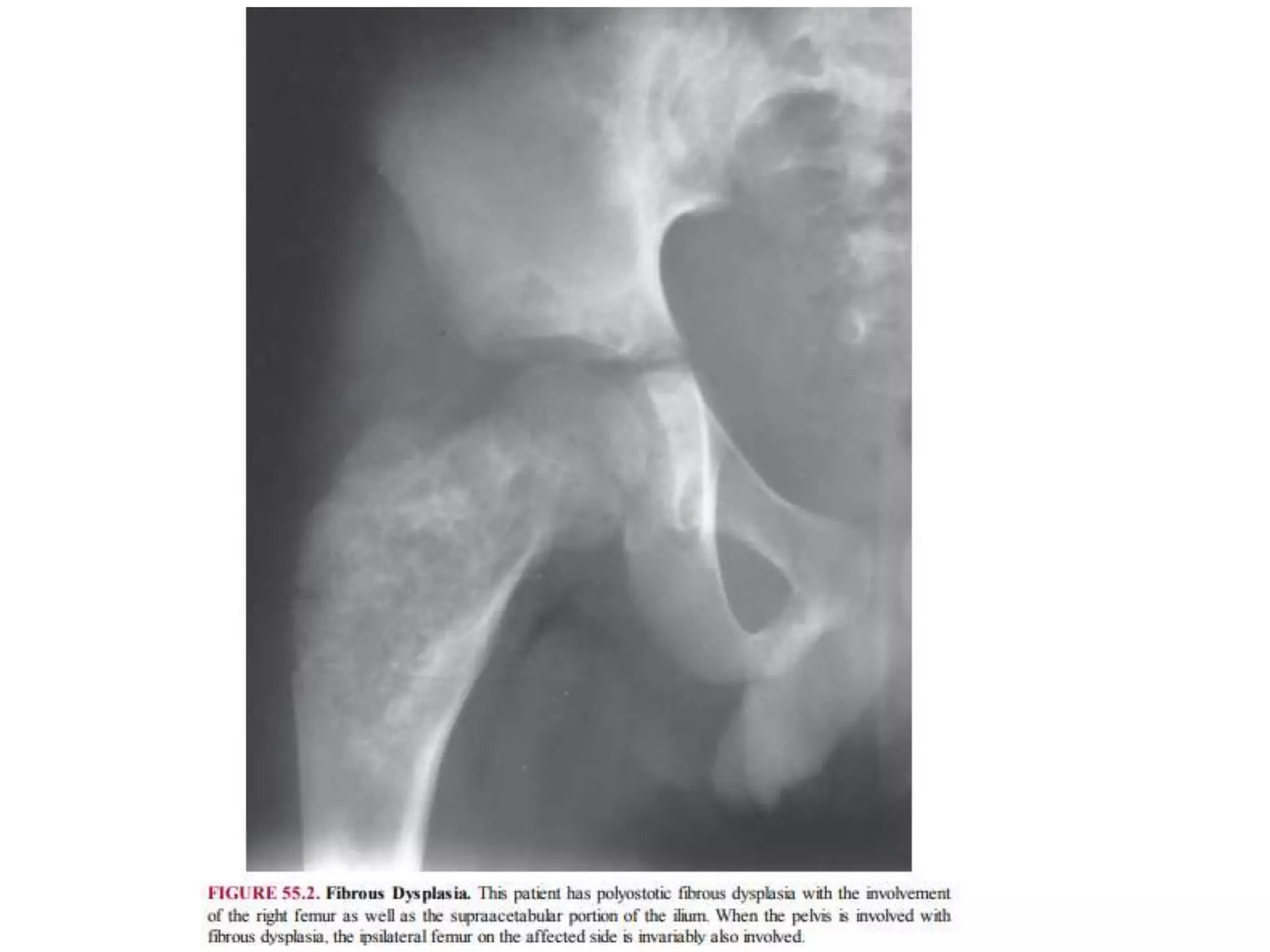 Lytic lesions of bone | PPTX