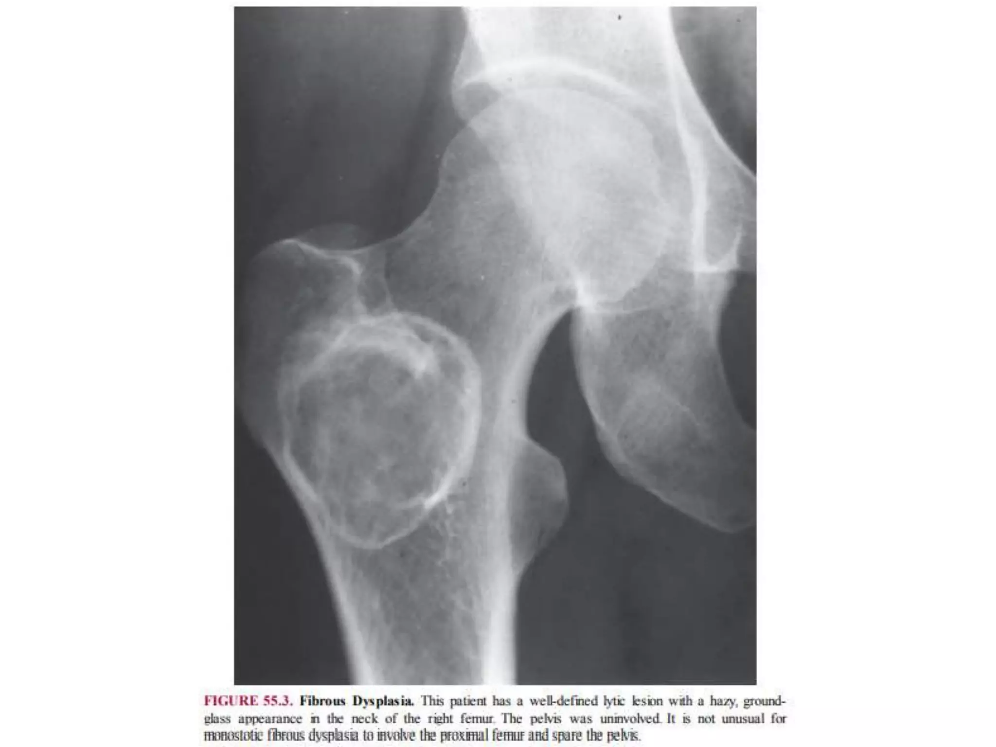 Lytic lesions of bone | PPTX