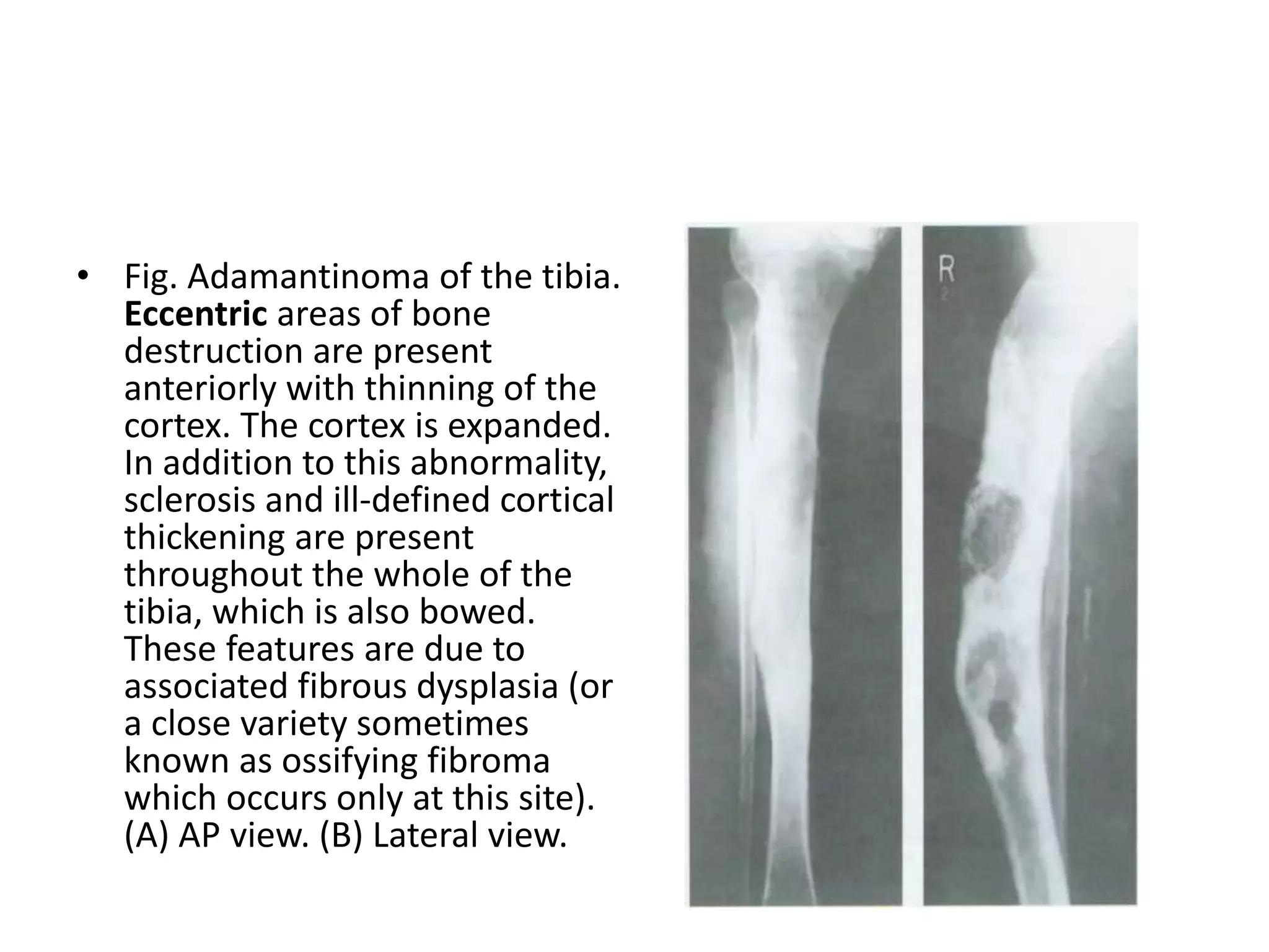 Lytic lesions of bone | PPTX