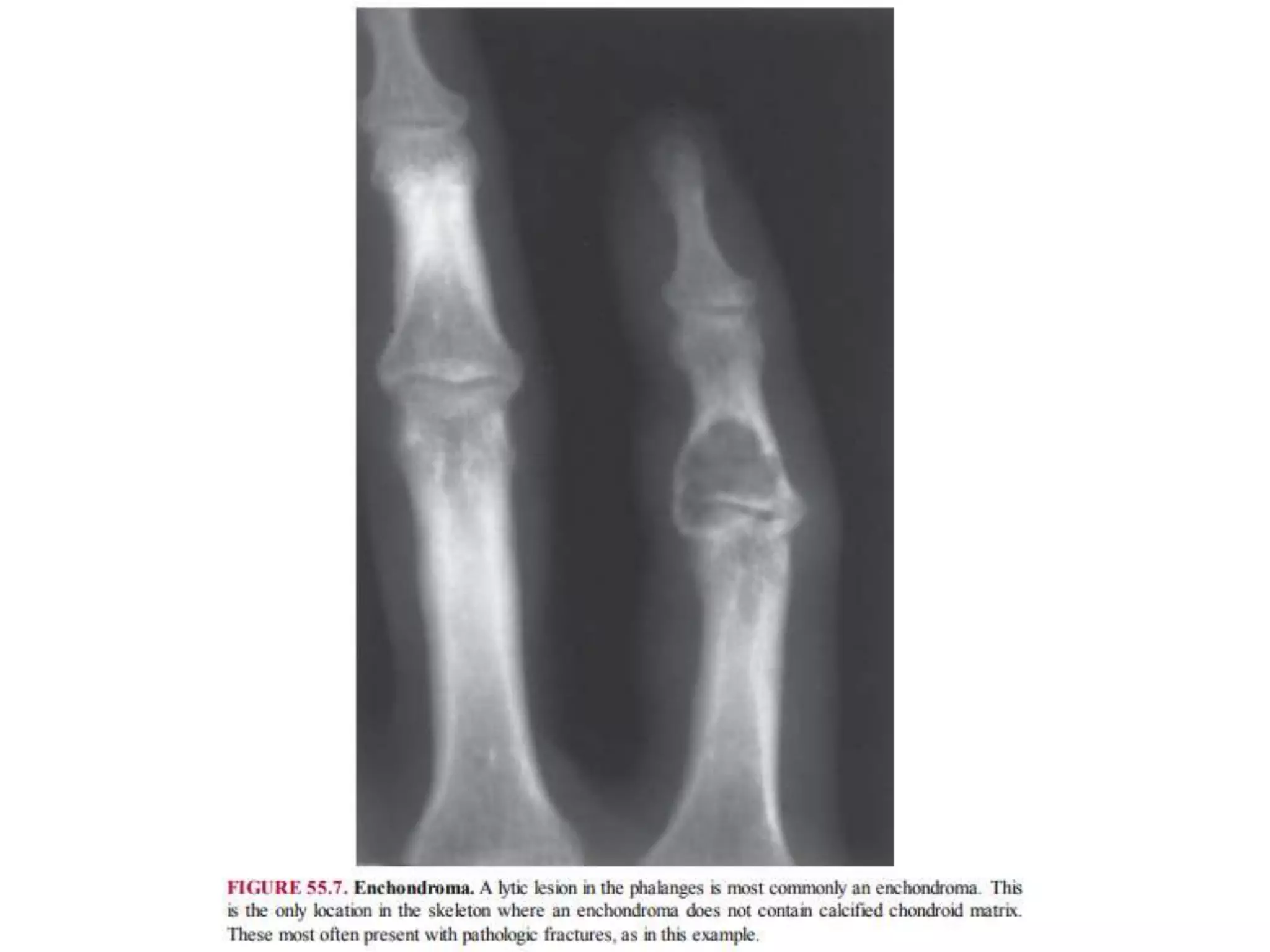 Lytic lesions of bone | PPTX